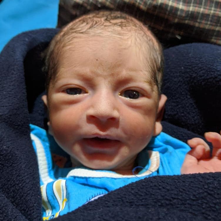 34 week posterior breech with cord prolapse and cervical head entrapment